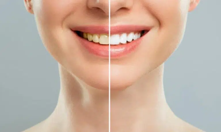 The 6 Most Common Toothpastes In The U.S. for Teeth Whitening