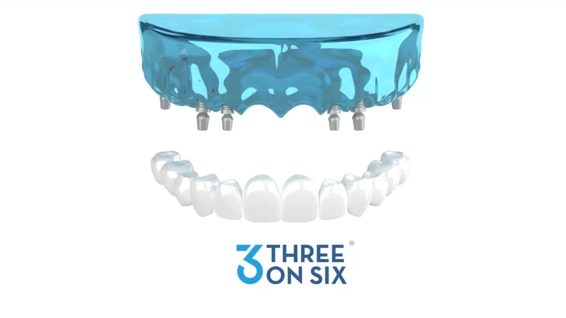 Get Radiant Smiles with 3 on 6 Full Mouth Implants in Sharpsville