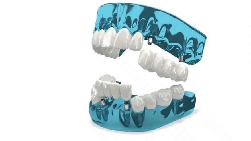 Full Mouth Implants: A Comprehensive Guide